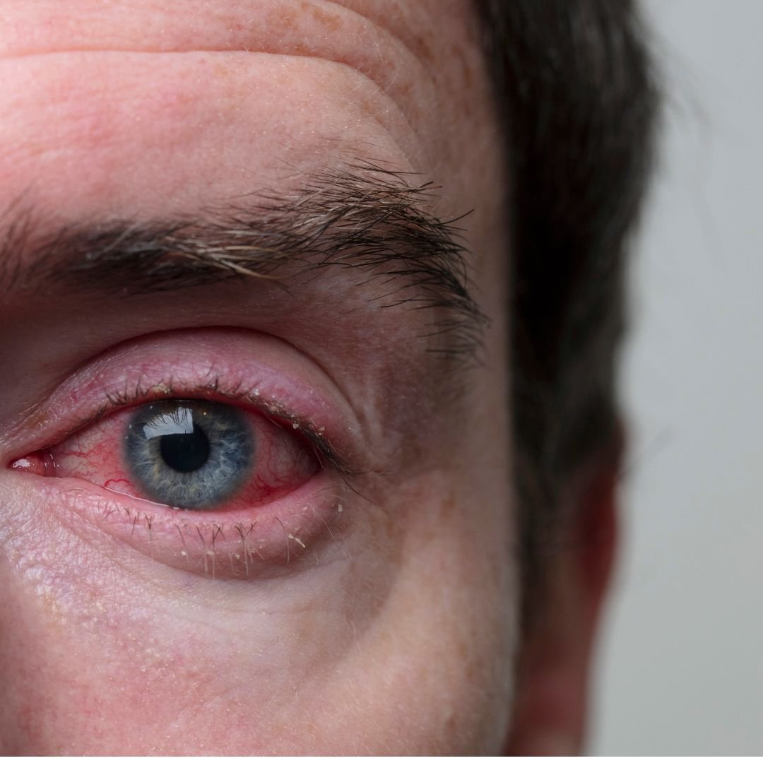 Conjunctivitis: Understanding the “Pink Eye” Infection